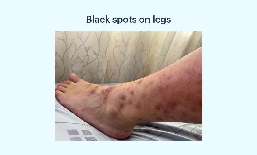 What Do Black Spots On My Body Mean - Infoupdate.org